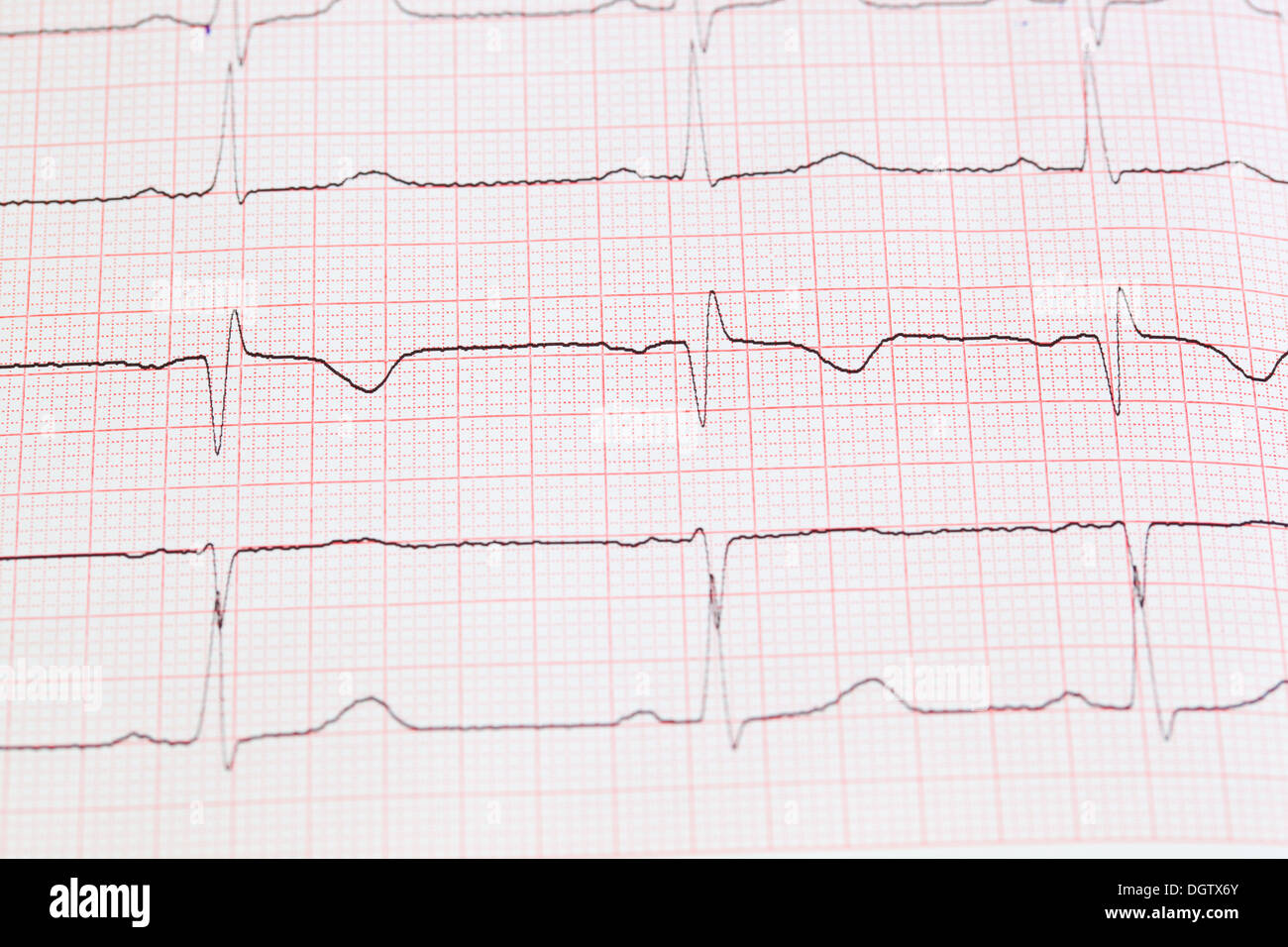 Eeg trace hi-res stock photography and images - Alamy
