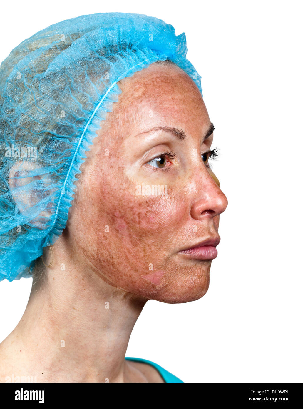Skin condition after chemical peeling TCA Stock Photo - Alamy