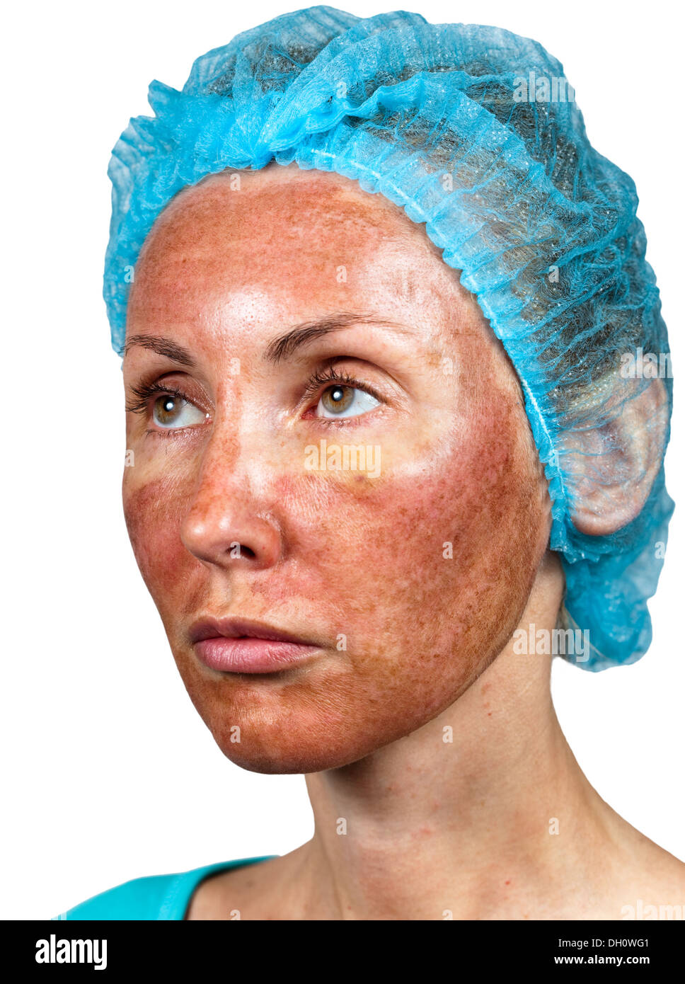 Skin condition after chemical peeling TCA Stock Photo - Alamy