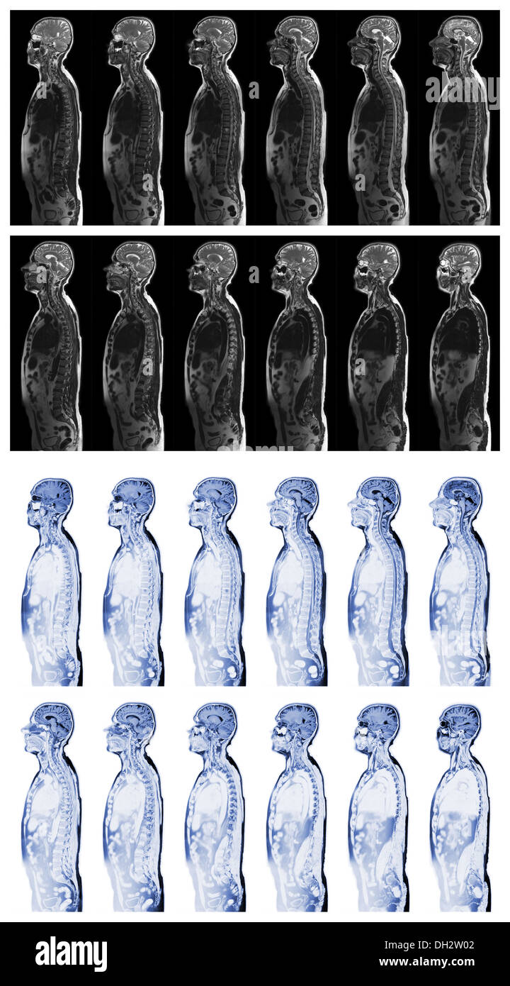 Mri sacrum hi-res stock photography and images - Alamy