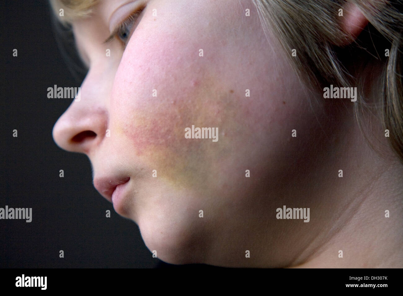 Bruised Face From Slap