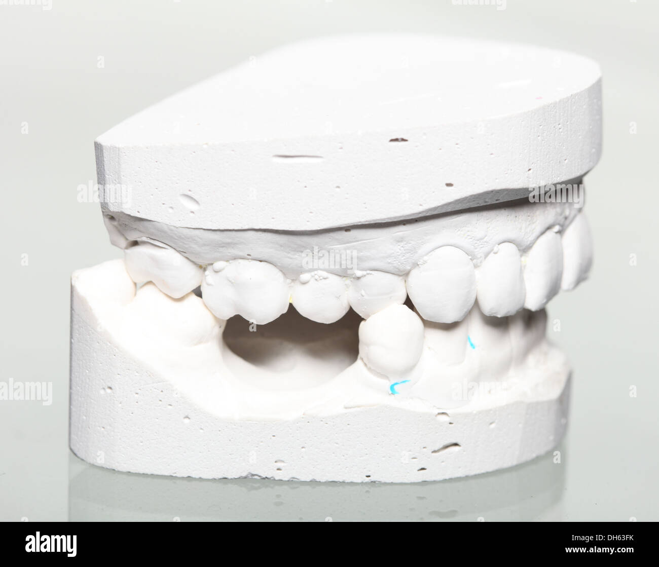 Dental casting gypsum model plaster cast stomatologic human jaws ...