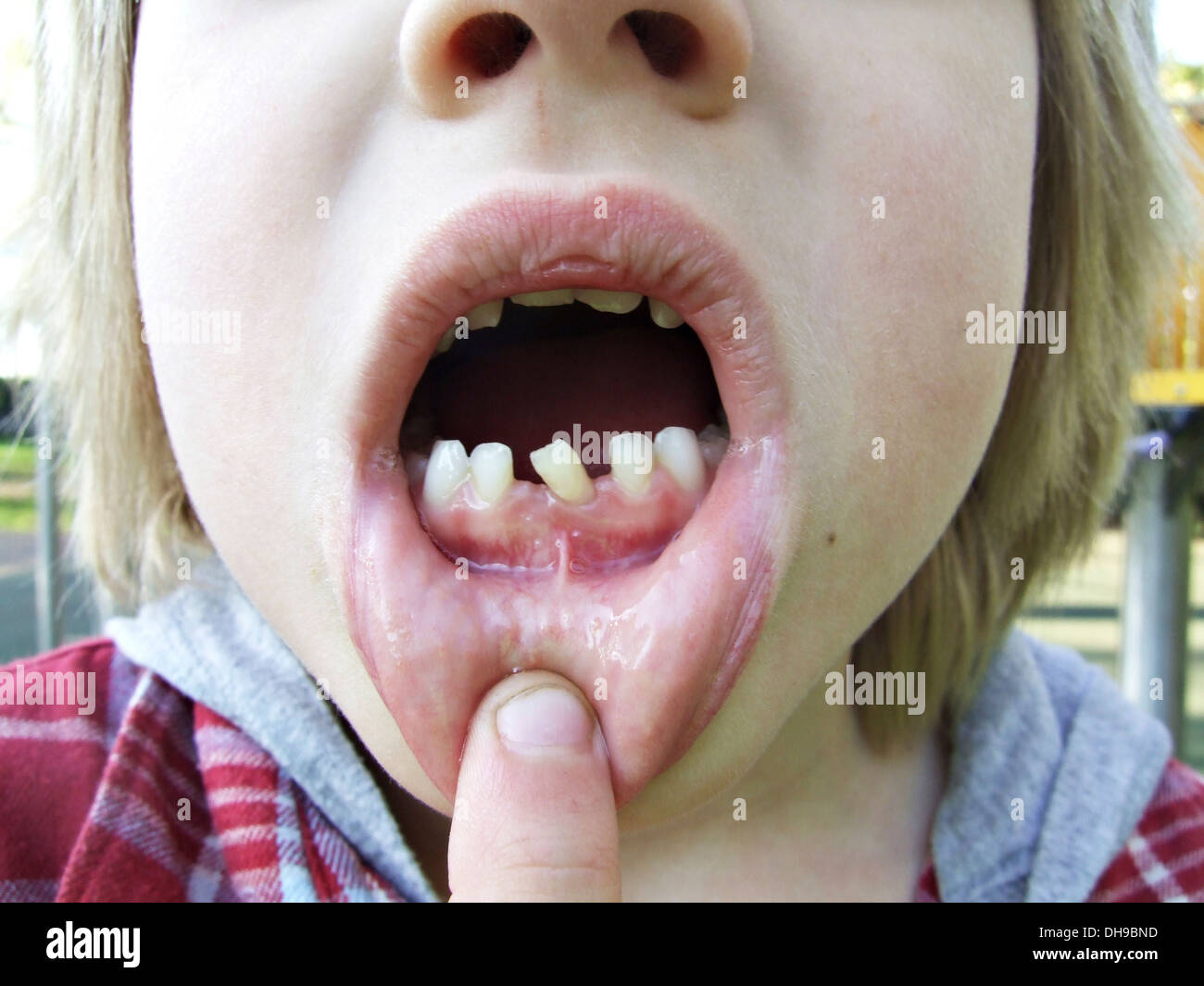 A child shows off his wobbly teeth Stock Photo - Alamy