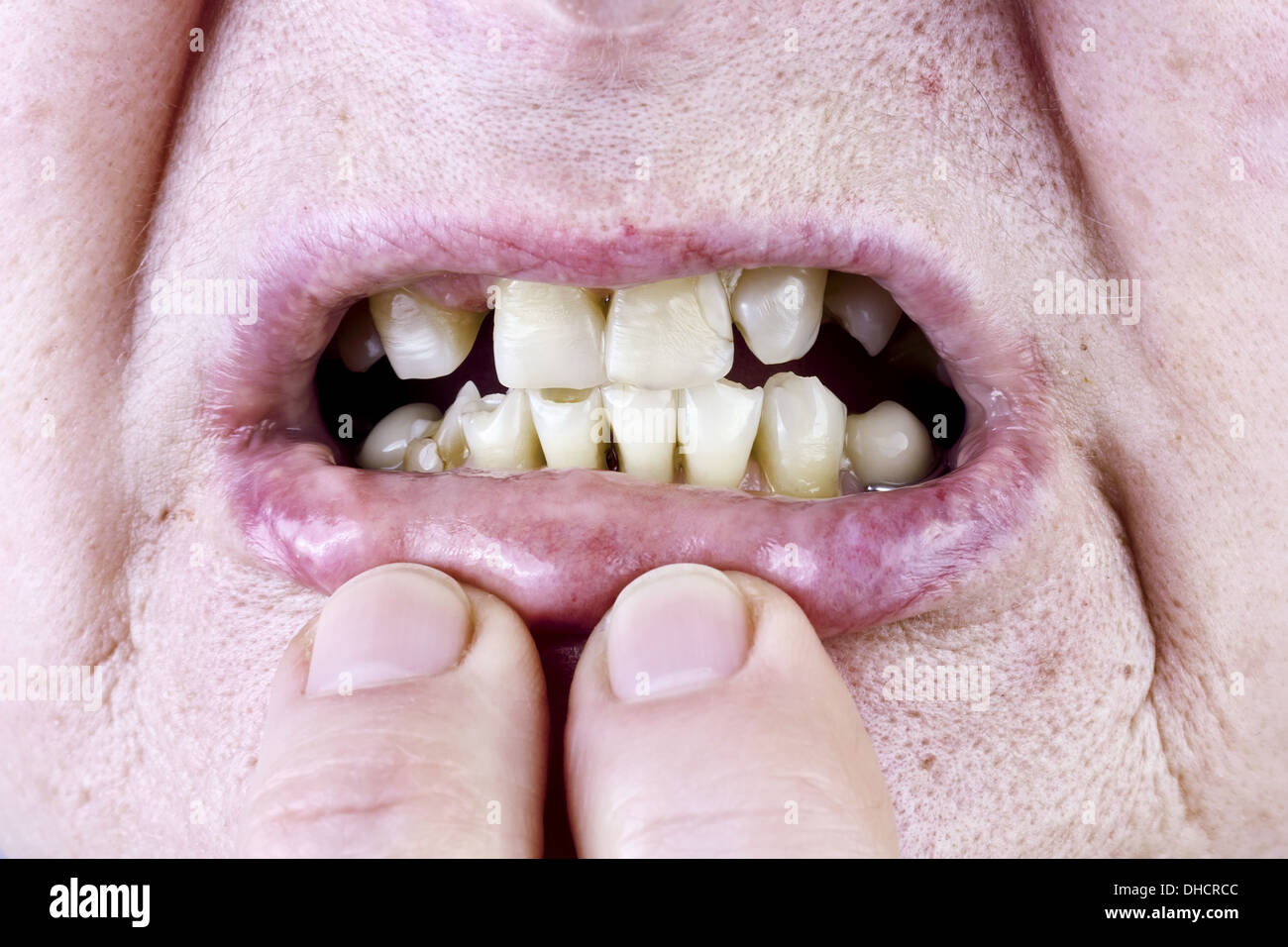 Yellow teeth studio shot Stock Photo - Alamy