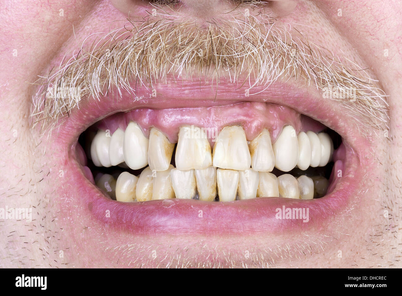 Yellow teeth studio shot Stock Photo - Alamy