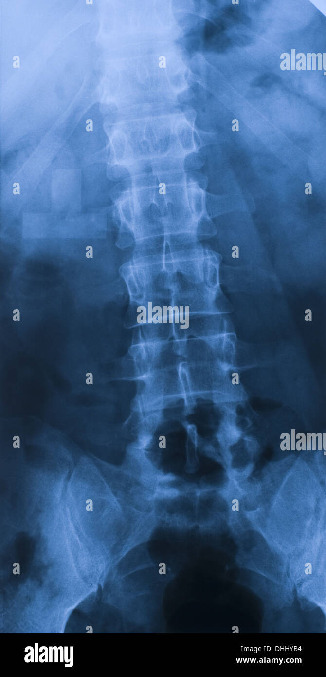 x ray of Columna vertebralis with Os sacrum Stock Photo - Alamy