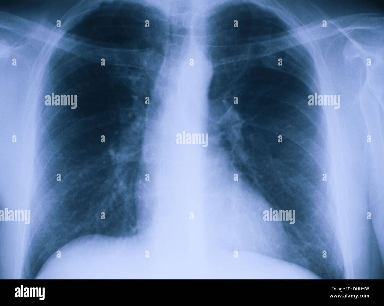Asthma x ray hi-res stock photography and images - Alamy