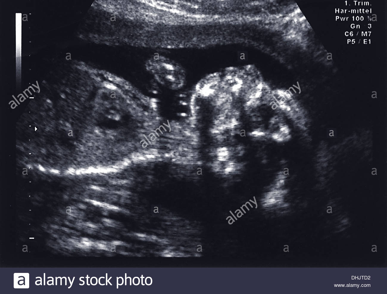 Ultrasonogram Stock Photos & Ultrasonogram Stock Images - Alamy