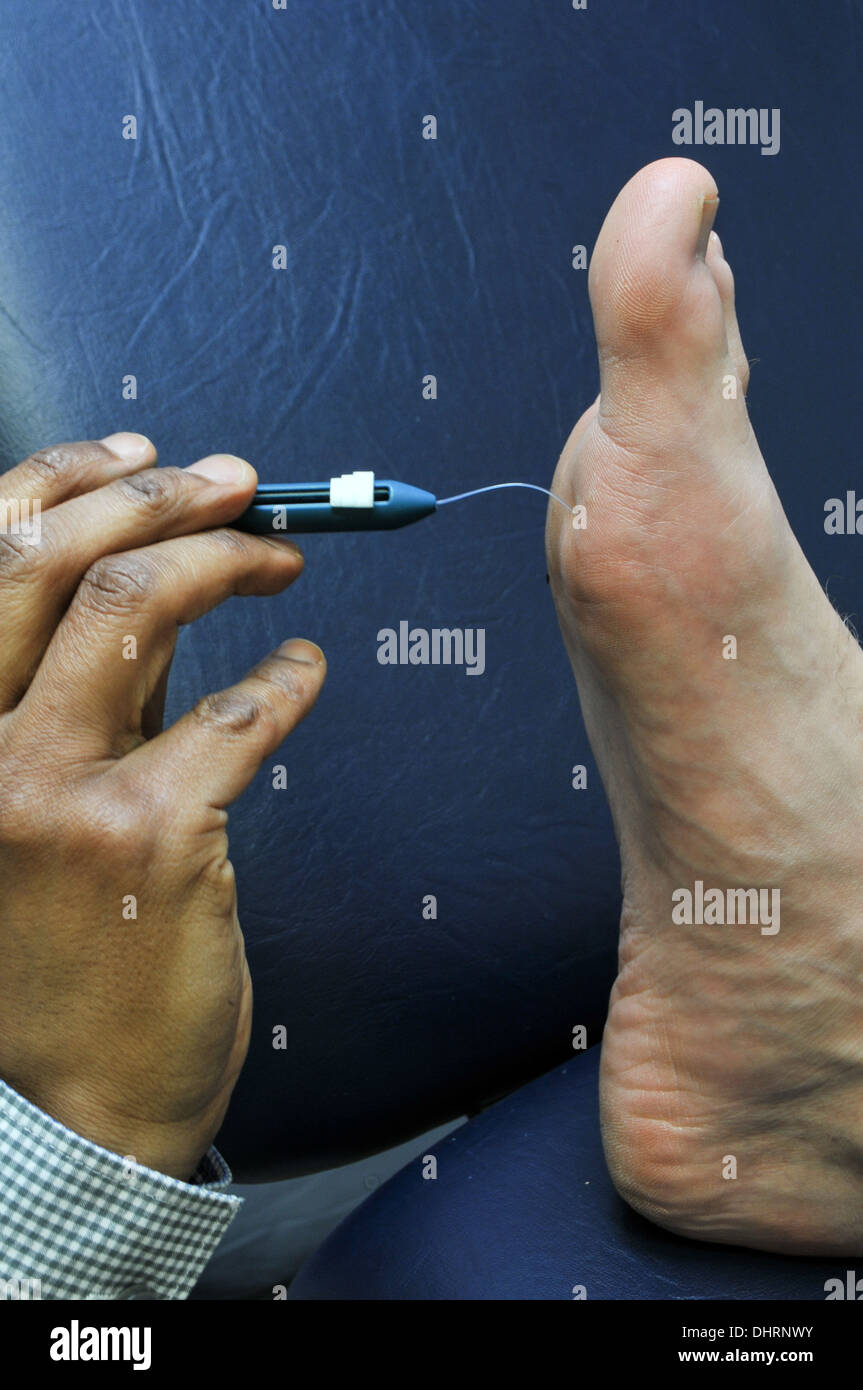 Testing the level of sensitivity in a Diabetic patients foot Stock ...