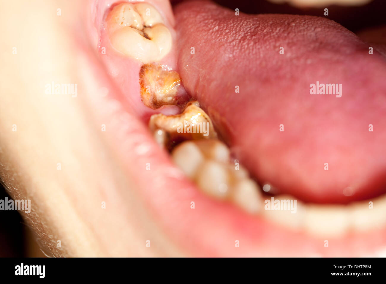 spoilt teeth in woman's open mouth Stock Photo - Alamy