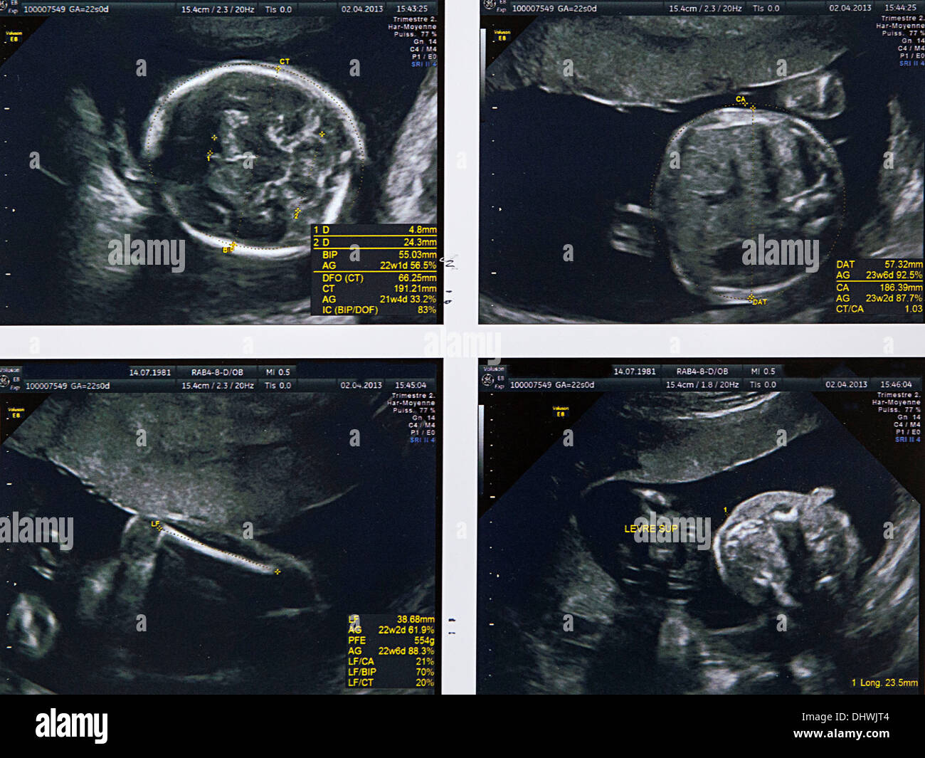 Fetus ultrasound 6 month hi-res stock photography and images - Alamy