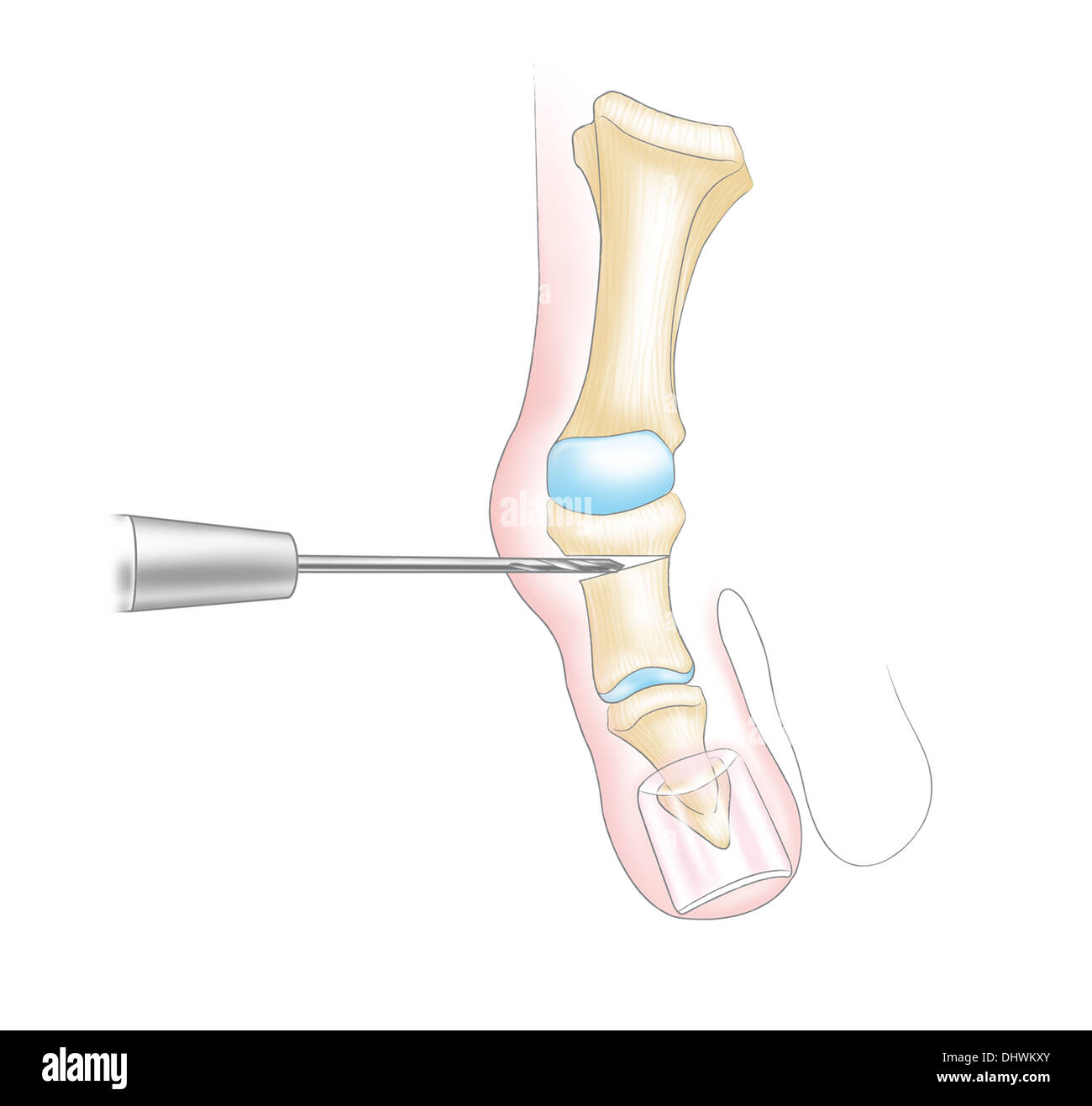 Hallux valgus illustration bunion hi-res stock photography and images ...