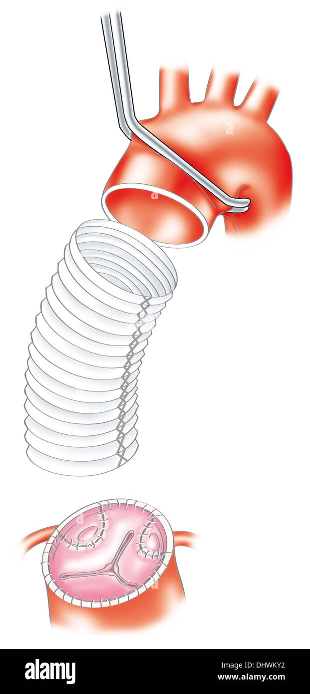 Cardiac surgery Cut Out Stock Images & Pictures - Alamy