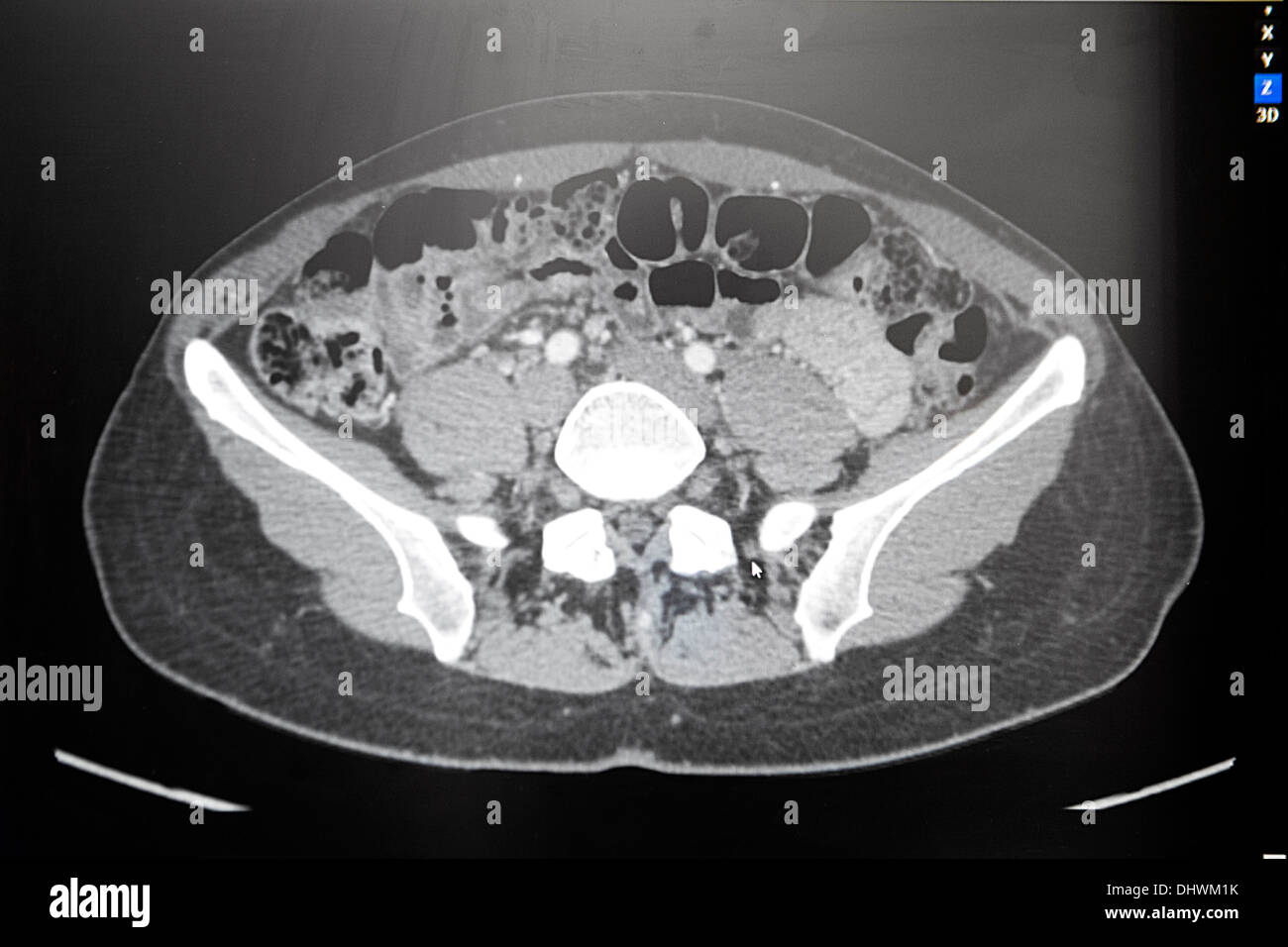 Ct pelvic bone 3d hi-res stock photography and images - Alamy