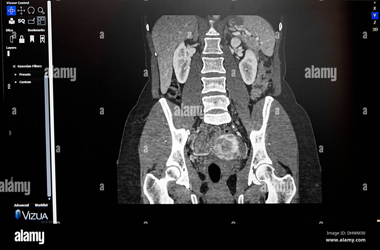 Ct pelvic bone 3d hi-res stock photography and images - Alamy