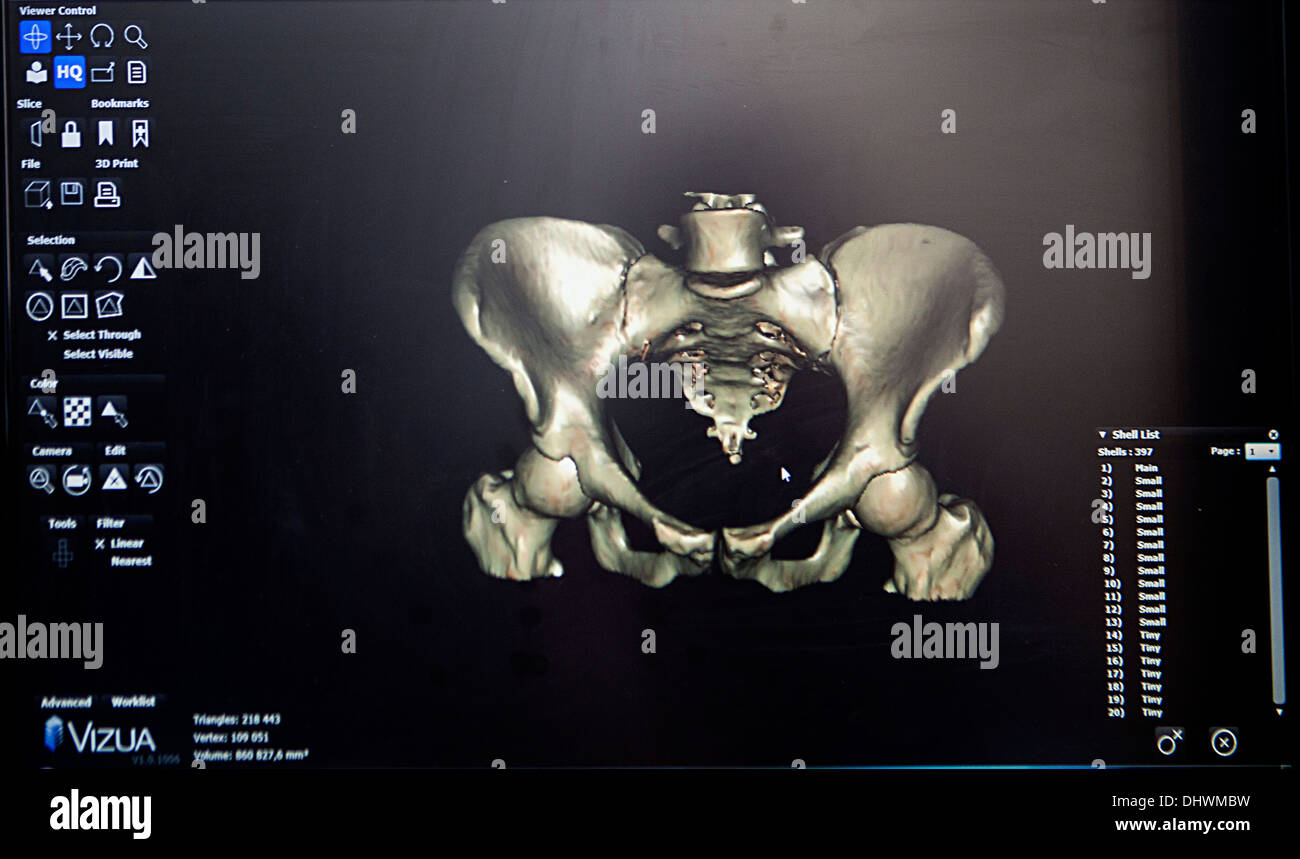 Ct Of The Pelvis High Resolution Stock Photography and Images - Alamy