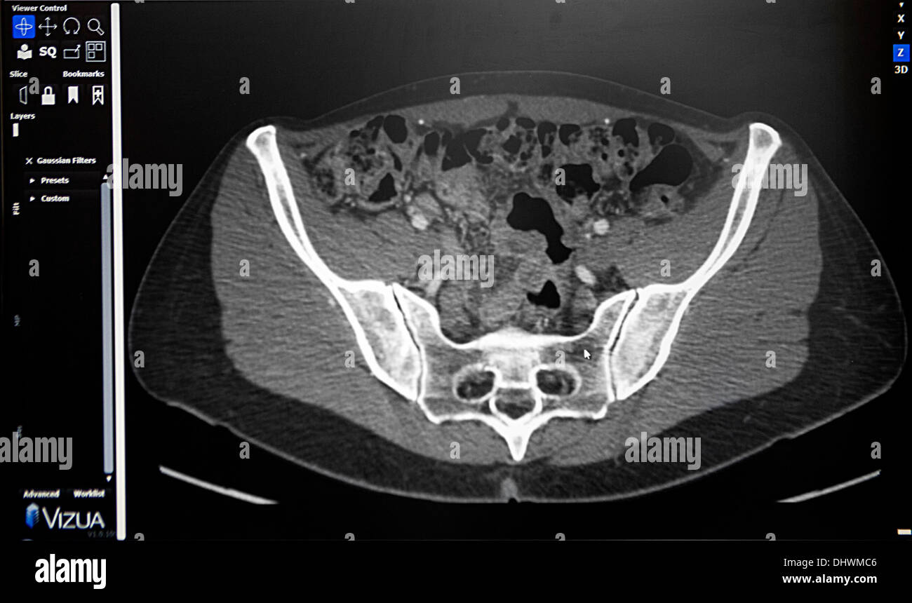 Pelvic ct scan hi-res stock photography and images - Alamy