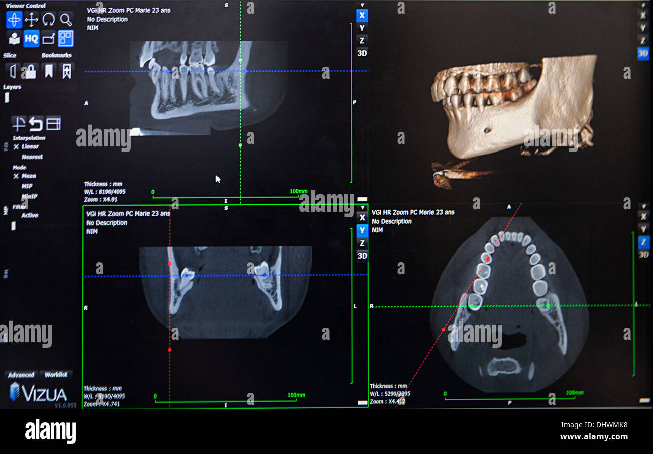3d printing technology bone hi-res stock photography and images - Alamy