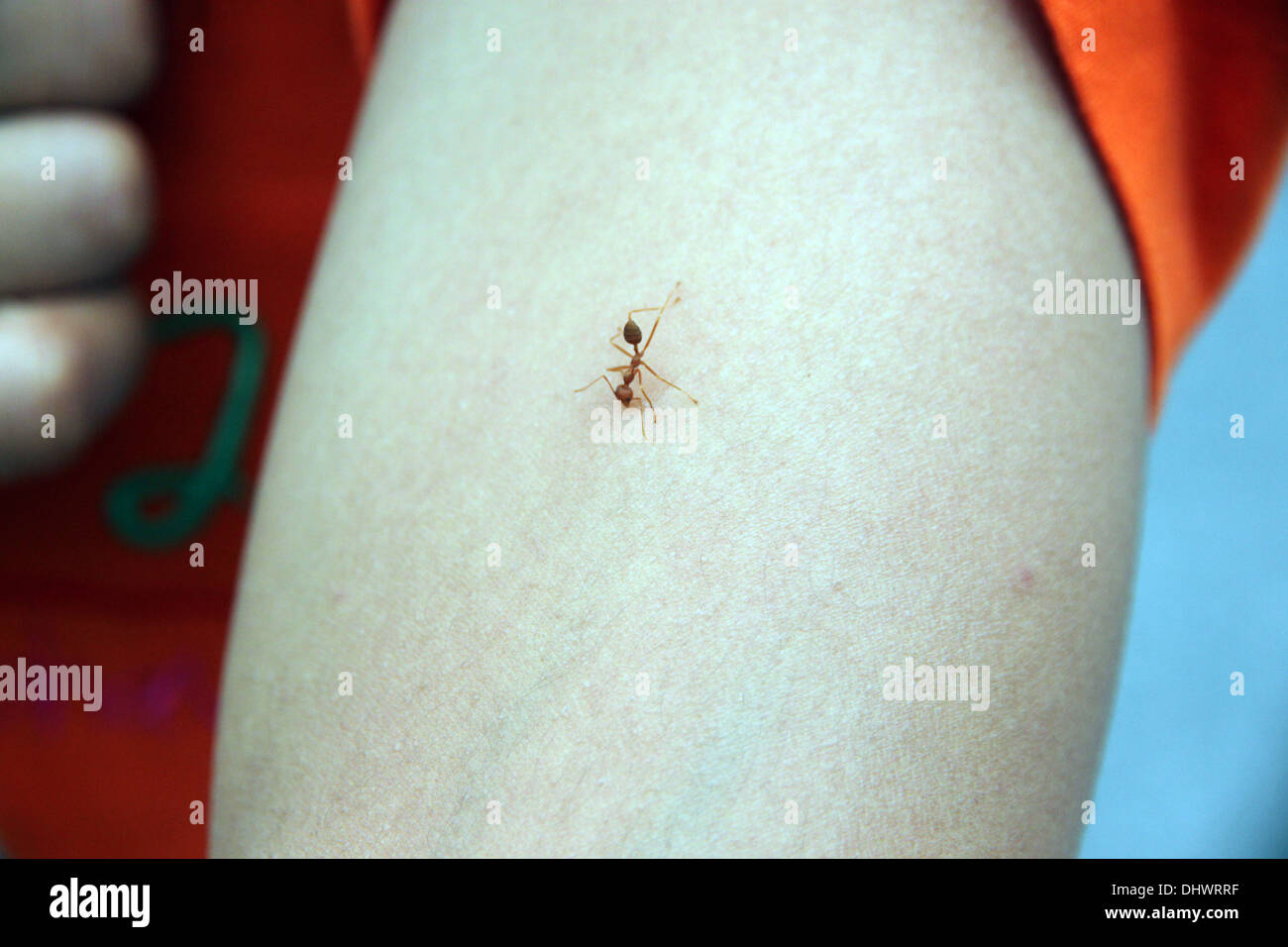 Was bitten by ant on the arm,It hurt a lot Stock Photo - Alamy