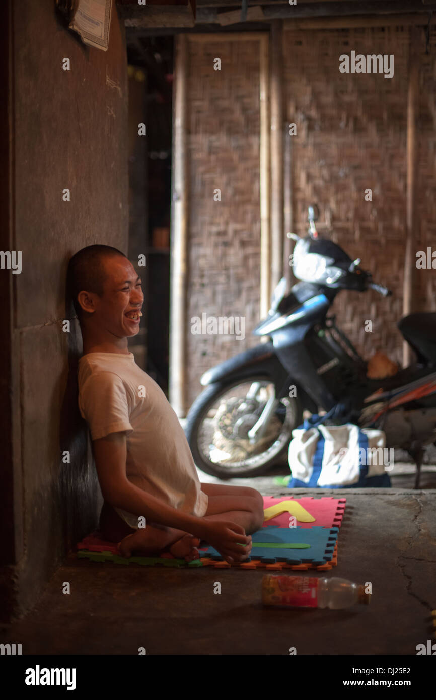 Boy young disfigured poor Bali poverty challenged extreme hold poor ...