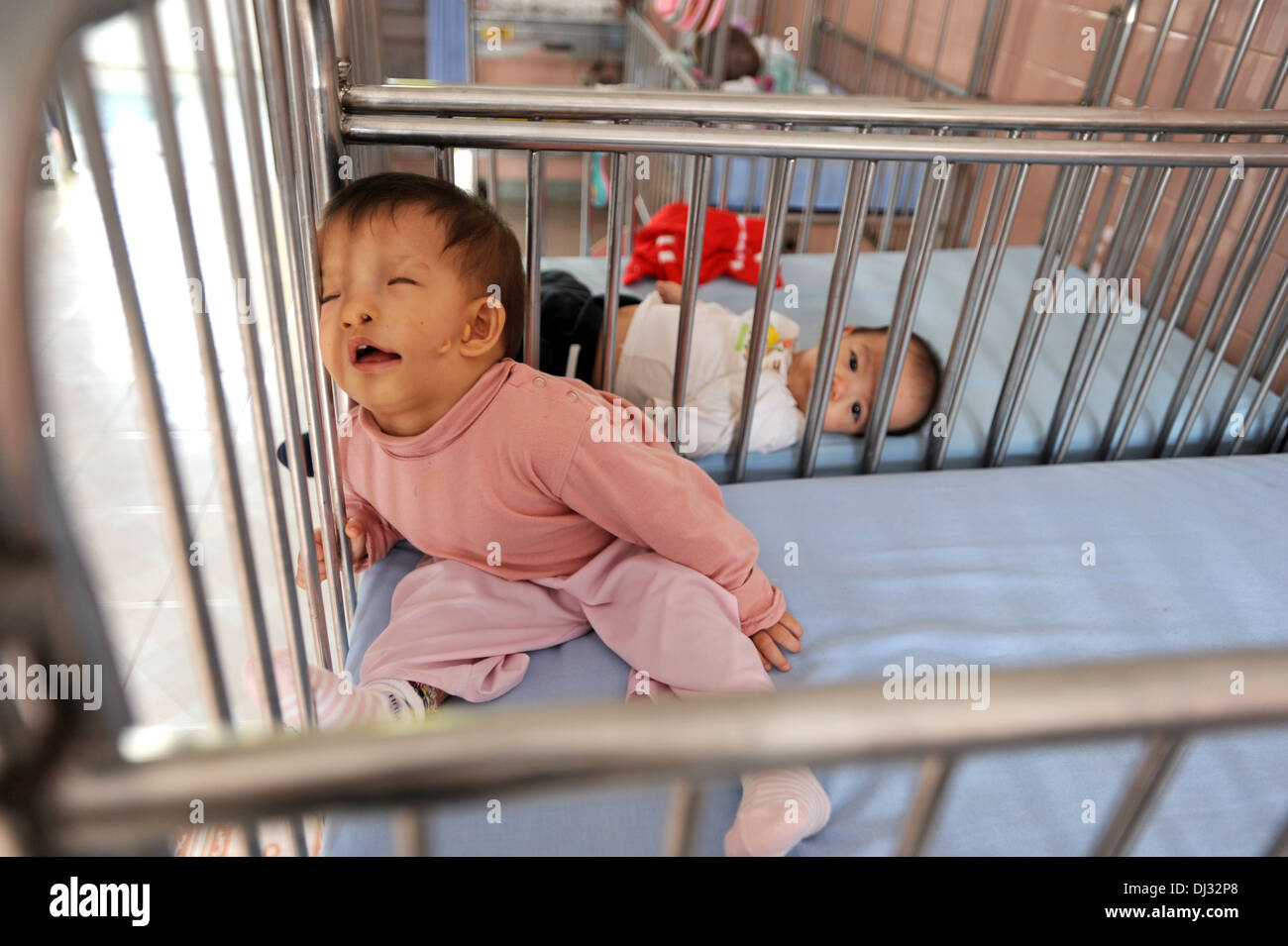 Deformities hi-res stock photography and images - Alamy