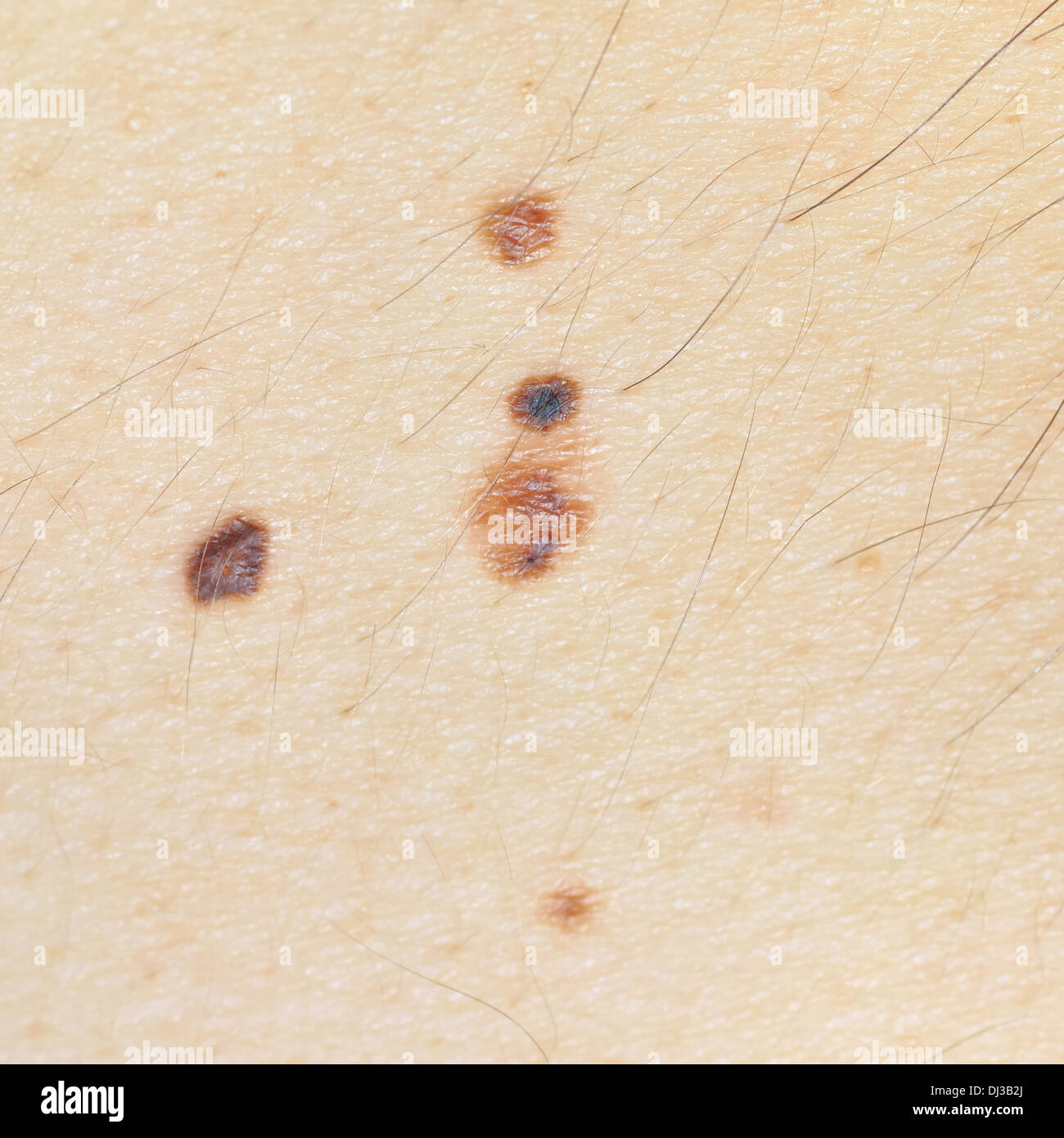 Melanoma mole on men hi-res stock photography and images - Alamy