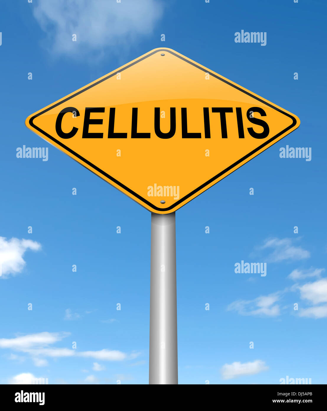 Cellulitis bacteria hi-res stock photography and images - Alamy