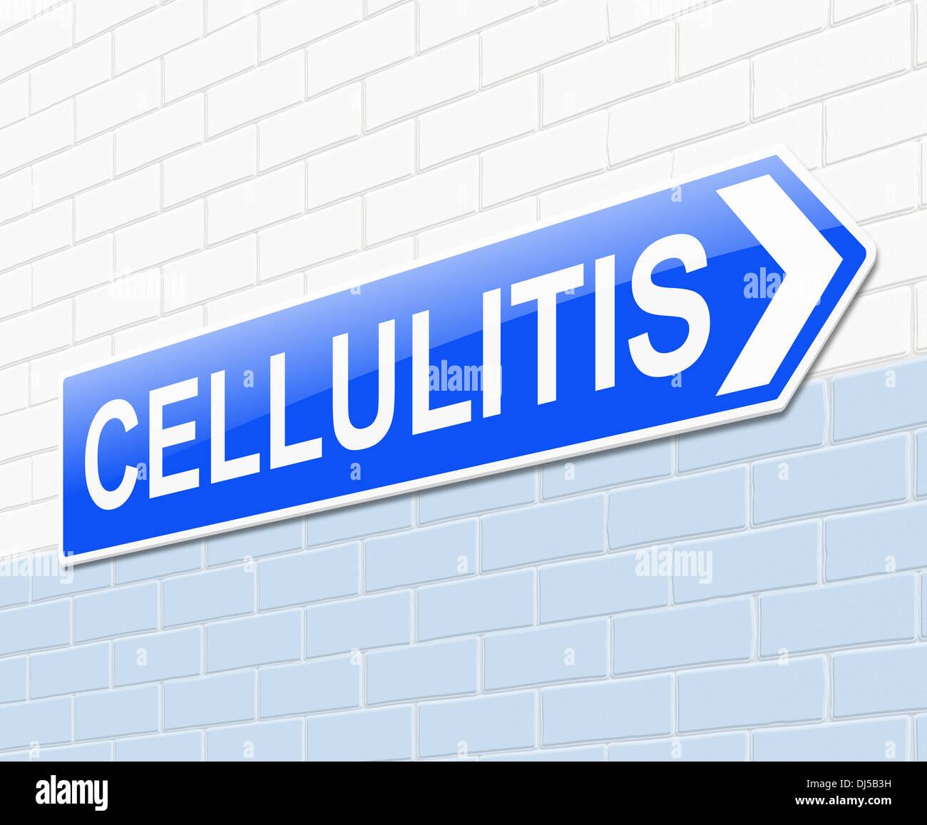 Cellulitis infection hi-res stock photography and images - Alamy