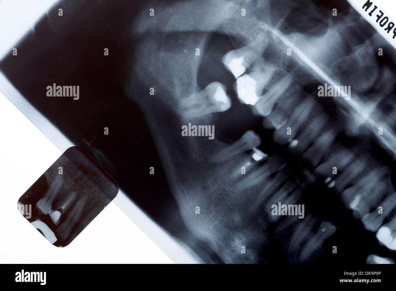 Panoramic and detail x-ray image scan of humans teeth Stock Photo - Alamy