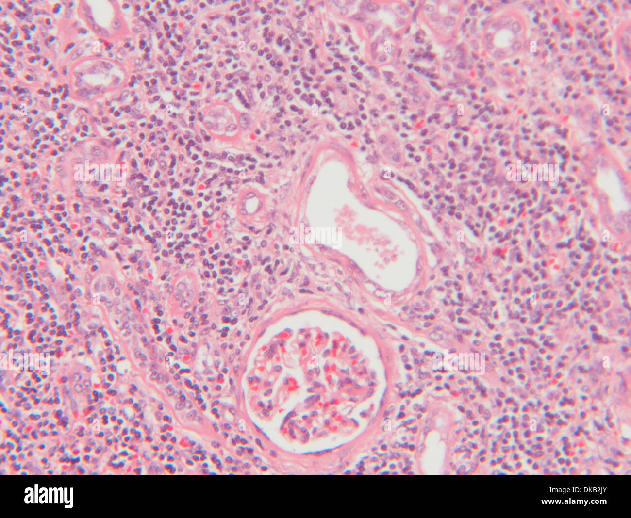Renal pathology hi-res stock photography and images - Alamy