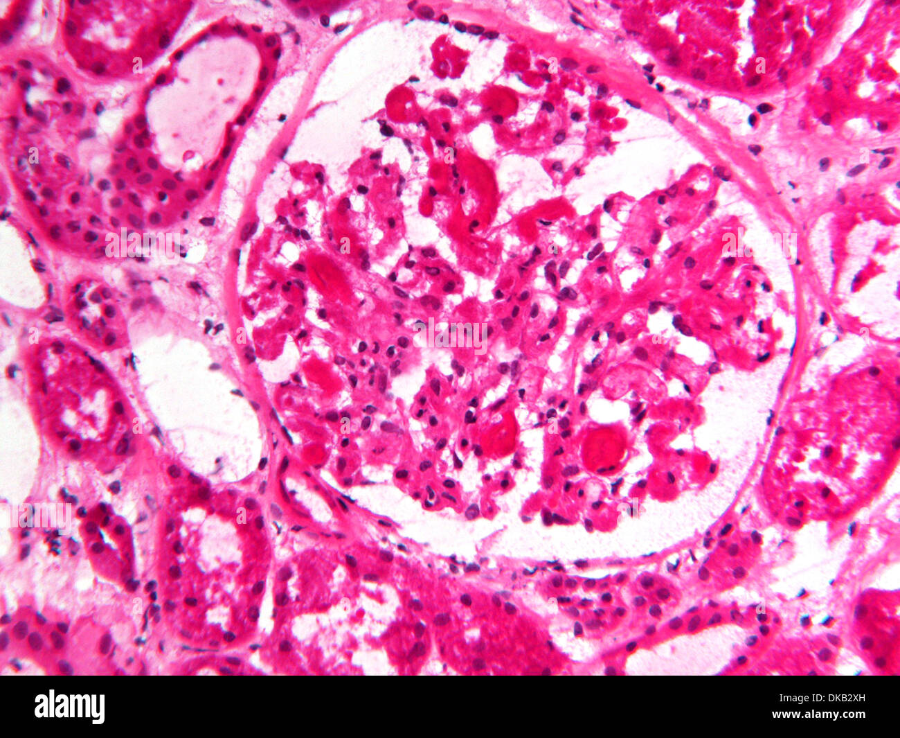 Histology micrograph of renal failure, showing interstitial Stock Photo ...