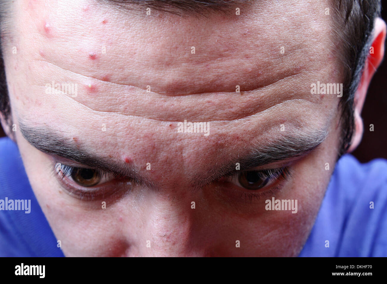 Acne pimples on the face of a young man Stock Photo - Alamy