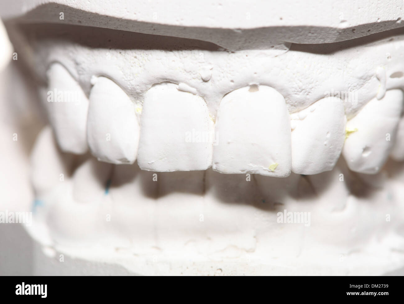 Dental casting gypsum model plaster cast stomatologic human jaws ...