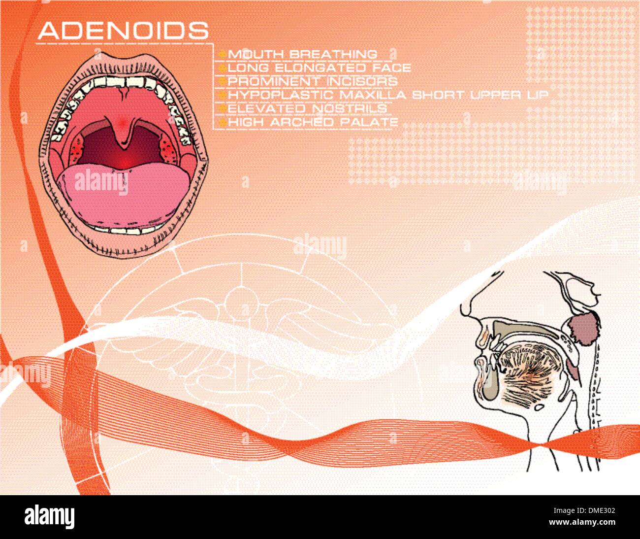 Adenoids hi-res stock photography and images - Alamy