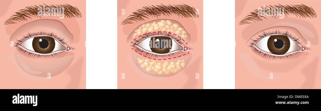 Blepharoplasty hi-res stock photography and images - Alamy