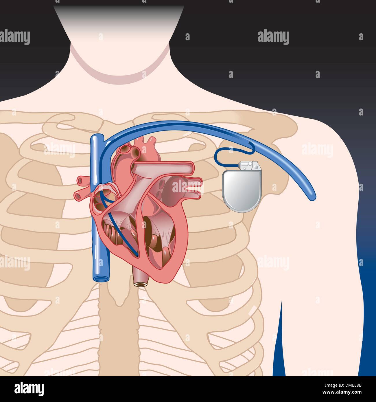 Pacemaker hi-res stock photography and images - Alamy