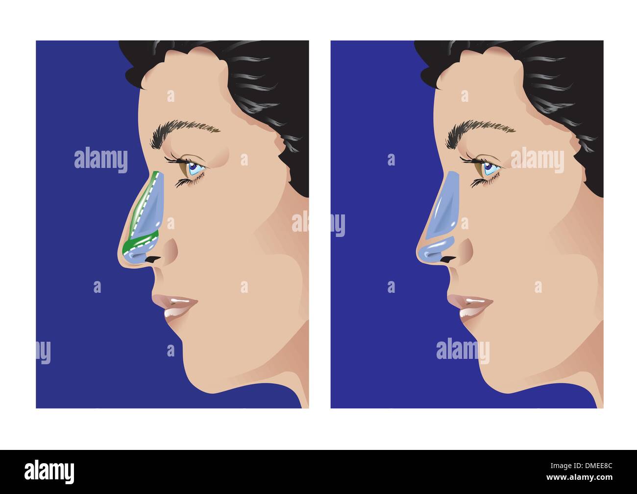 Rhinoplasty vector vectors Cut Out Stock Images & Pictures - Alamy