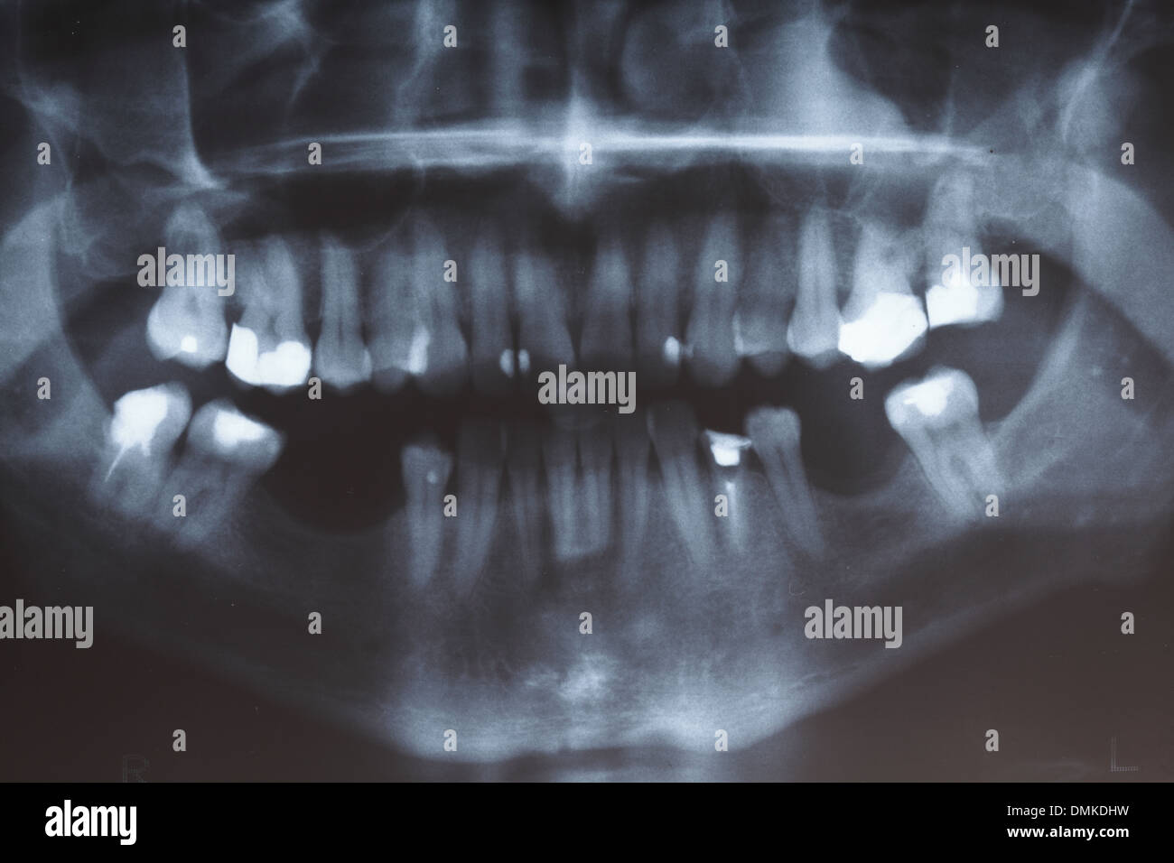 Panoramic x-ray image scan of humans teeth Stock Photo - Alamy