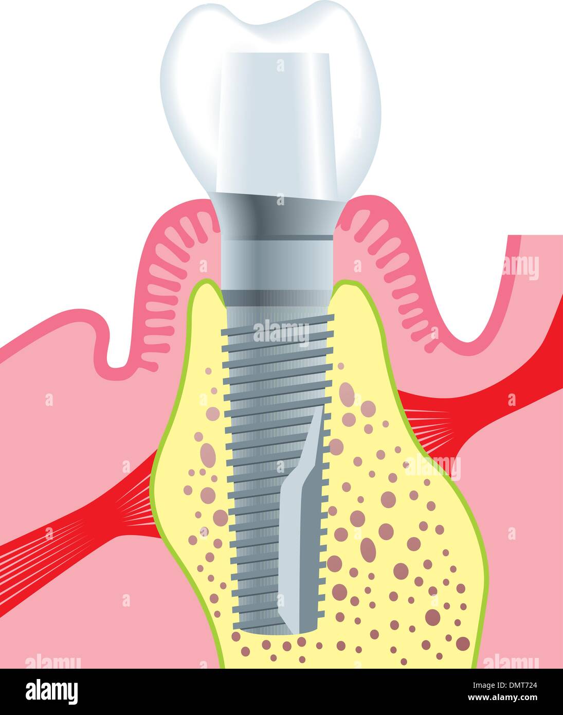 Dental implant hi-res stock photography and images - Alamy