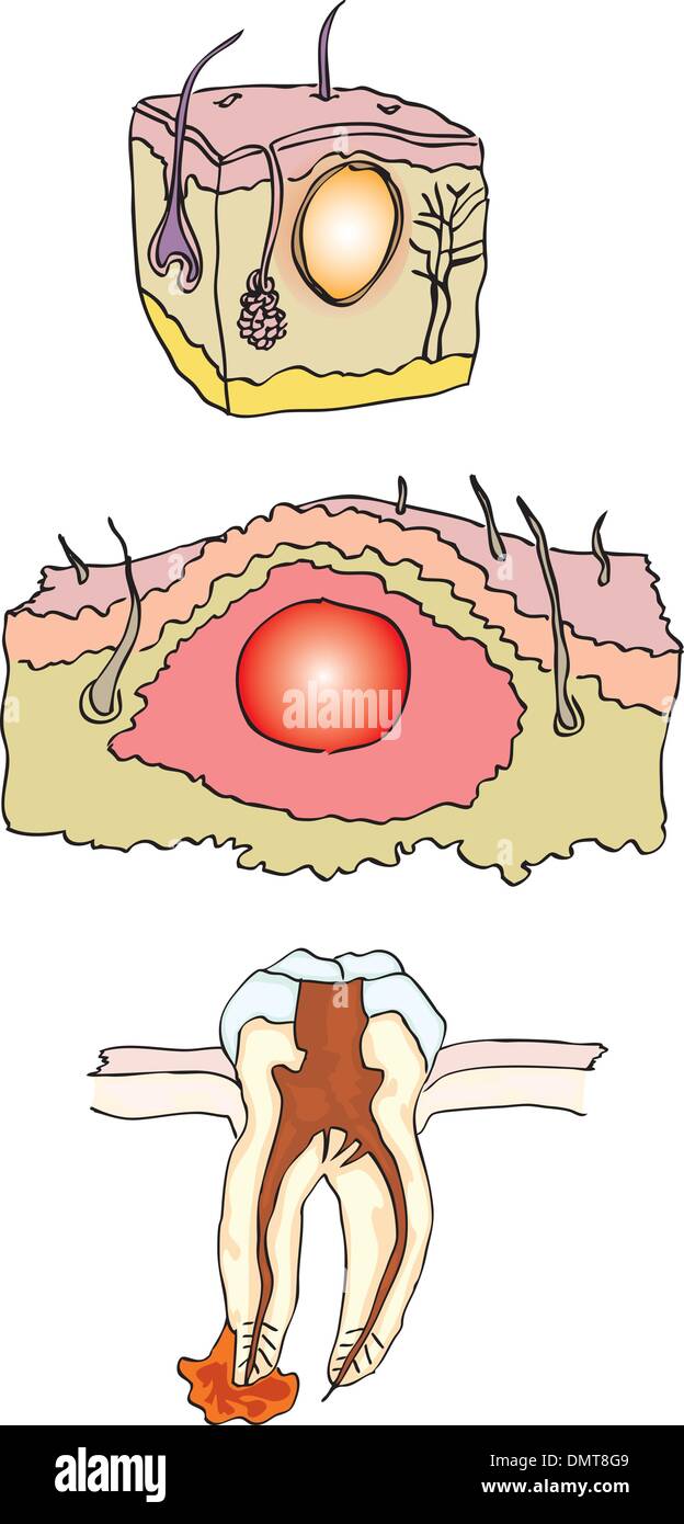 Abscess hi-res stock photography and images - Alamy