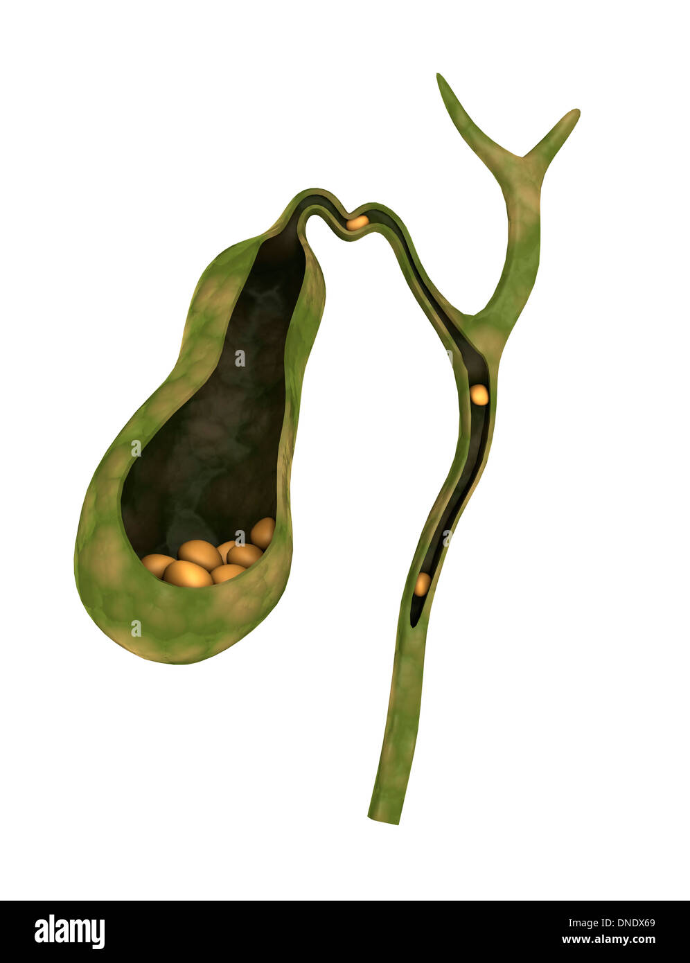 Conceptual image of gallstones inside gall bladder Stock Photo ...
