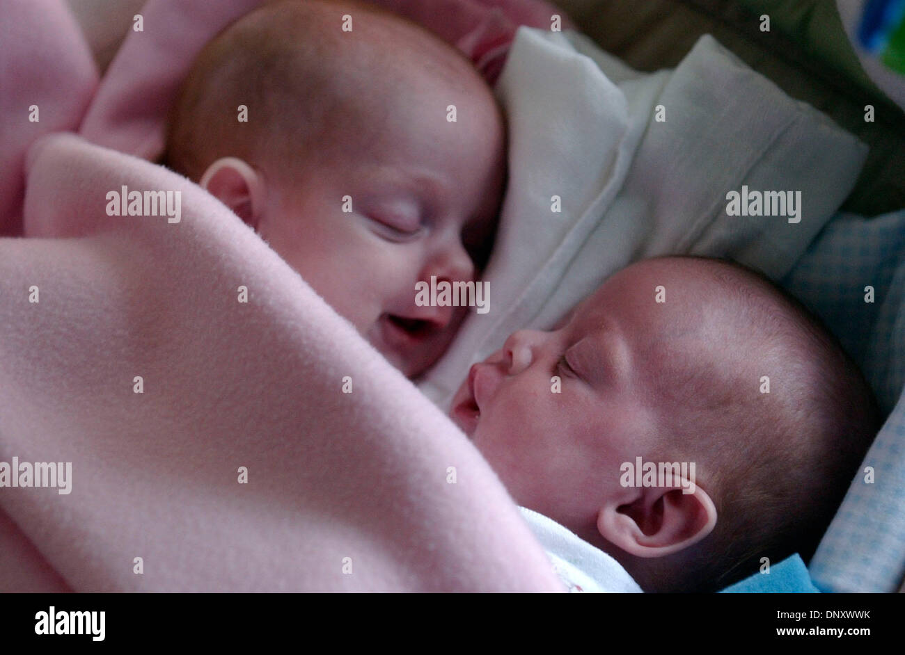 Conjoined Twins Separated High Resolution Stock Photography and Images ...