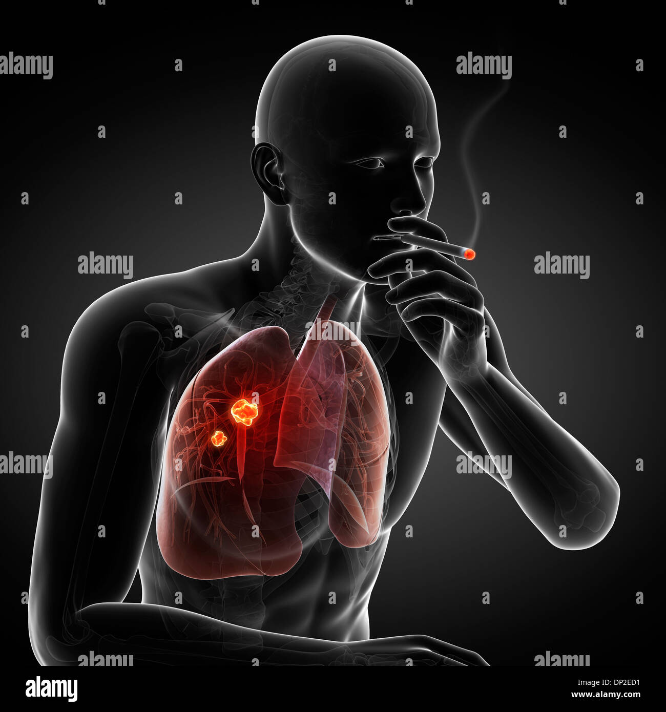 Smoking cancer hi-res stock photography and images - Alamy