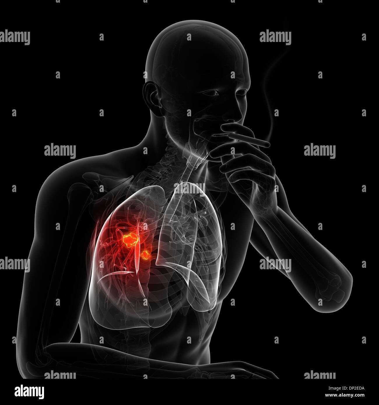 Smoking cancer hi-res stock photography and images - Alamy