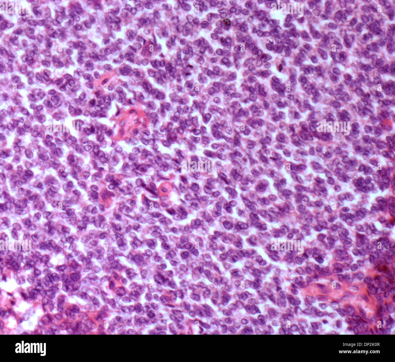 Bone cancer hi-res stock photography and images - Alamy