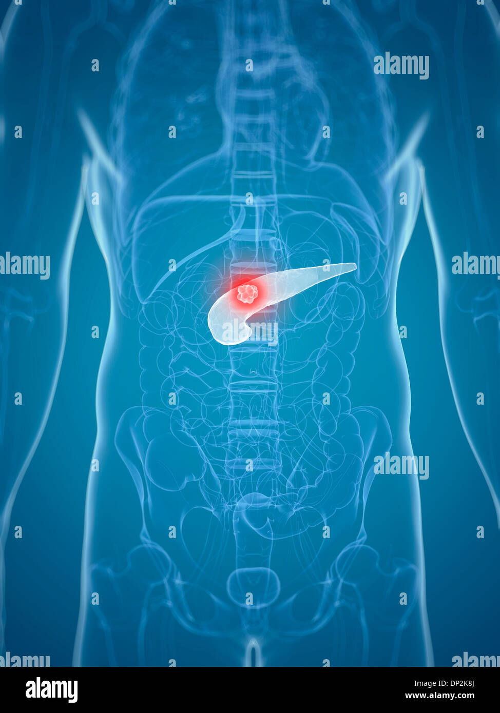 Pancreatic cancer hi-res stock photography and images - Alamy