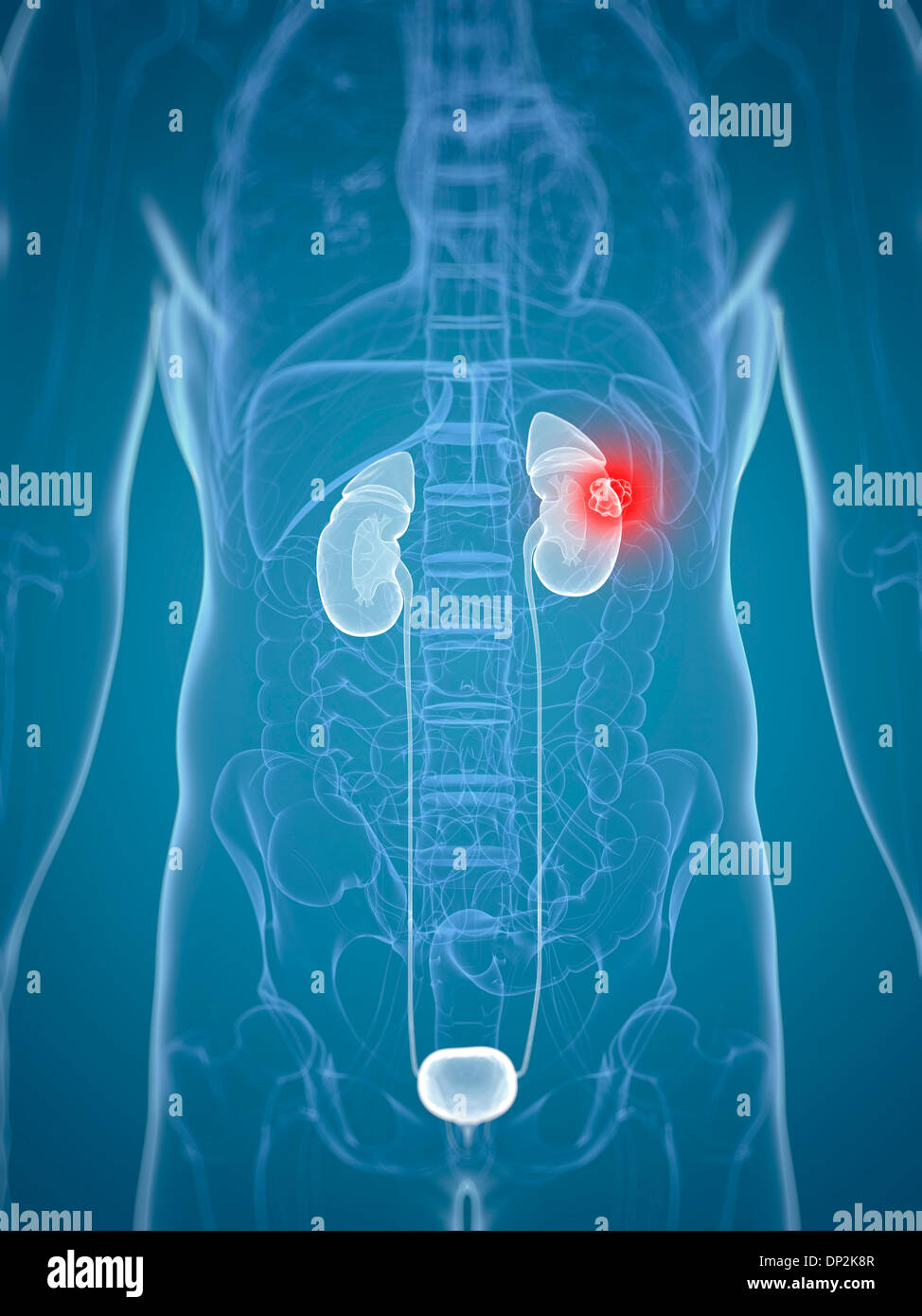 Male kidney cancer hi-res stock photography and images - Alamy