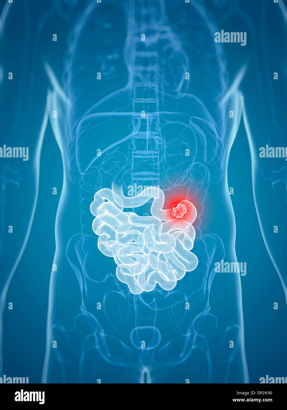 Intestinal cancer, artwork Stock Photo - Alamy