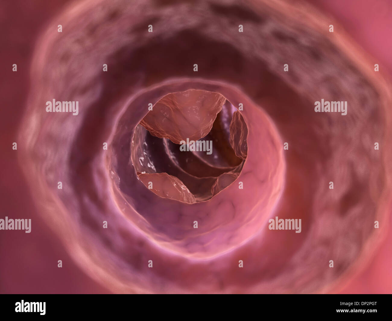 Colon inflammation hi-res stock photography and images - Alamy
