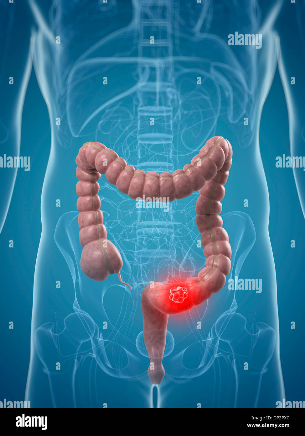 Colon cancer, artwork Stock Photo - Alamy